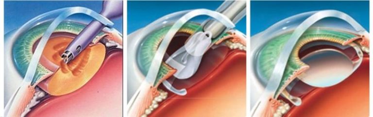 MICS (Micro Incision Cataract Surgery) Surgery in Delhi- Cost, Hospital ...