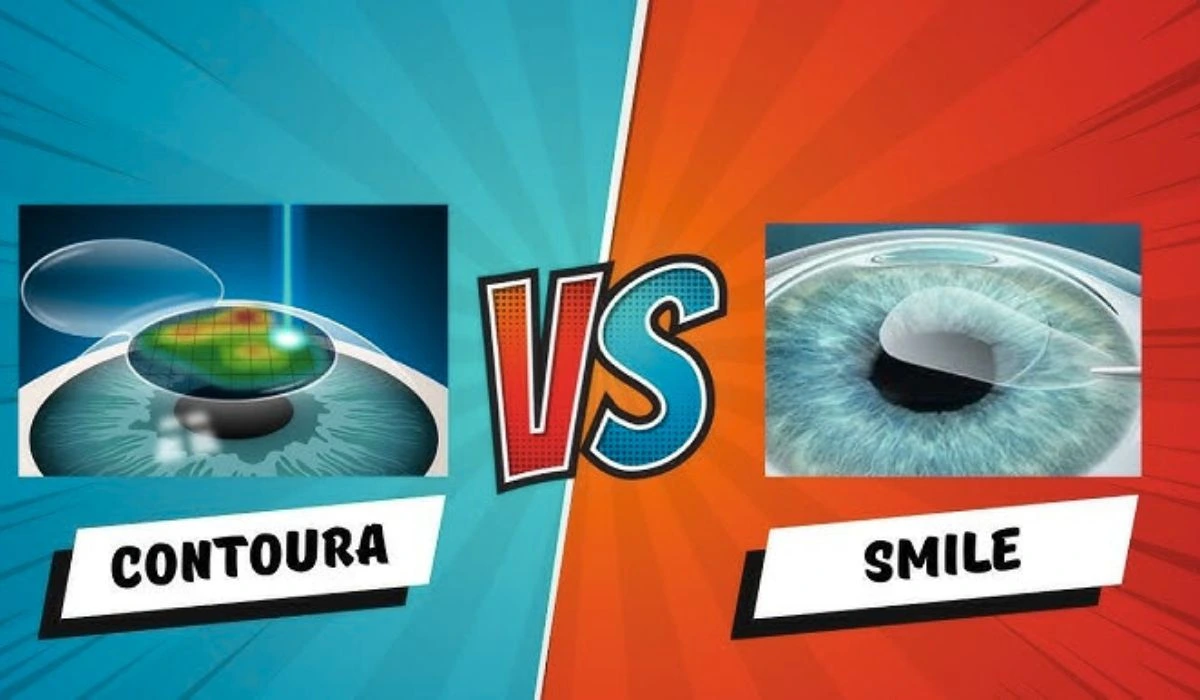 SMILE Surgery vs Contoura Vision: Which Is the Best Choice for Clear ...
